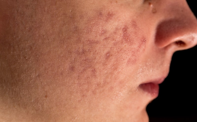 Treating acne in Vienna with laser - gentle and effective